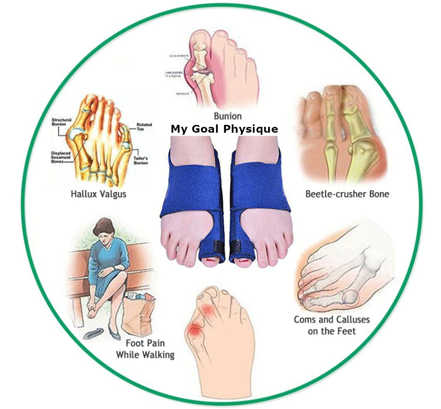Bunion Brace – My Goal Physique